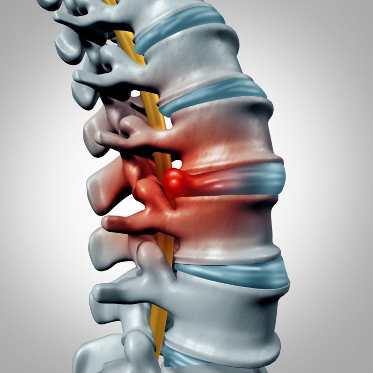 Heal Your L5-S1 Disc Herniation with Expert Care – Minnesota Spine ...